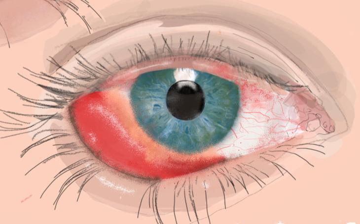 Chemosis Symptome - so erkennst Du die Schwellung