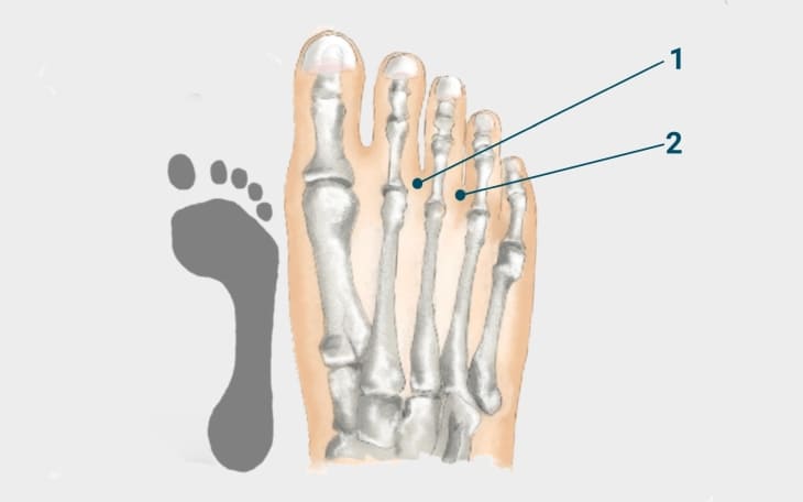 Morton Neurom - Ursachen, Behandlung & Prognose