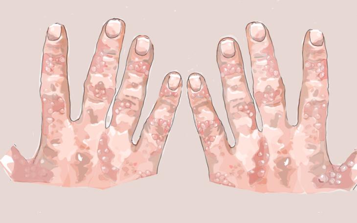 Handpilz - schnell erkannt, einfach behandelt