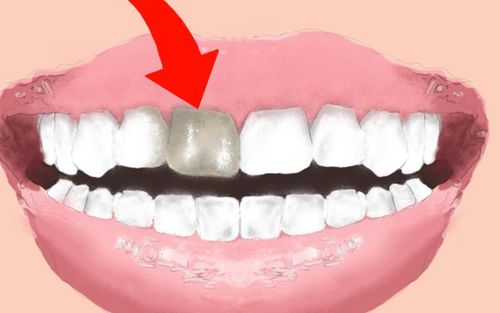 Pulpanekrose - Symptome, Behandlung, Ursachen & Prognose